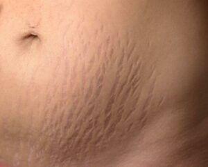 How to Treat Stretch Marks During Pregnancy | What to Avoid